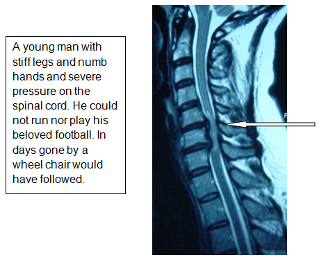 Cervical vertebrectomy